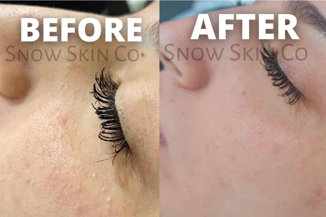 Snow Fibroblast Plasma Pen - Snow Skin Co