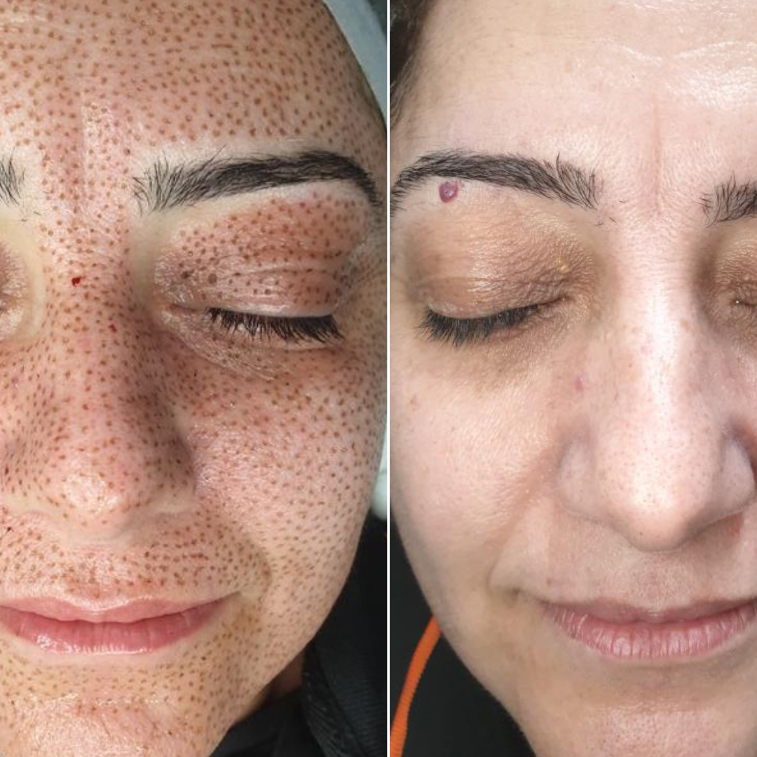 3 Snow Fibroblast Plasma Pen Kits